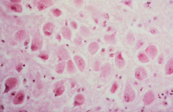 Neuronal Ceroid Lipofuscinosis Pictures