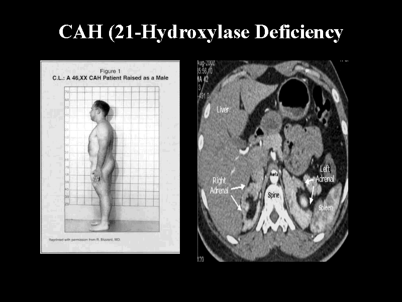 Cah 21 Hydroxylase Deficiency