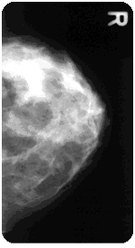 Metanews: Mammography in the media