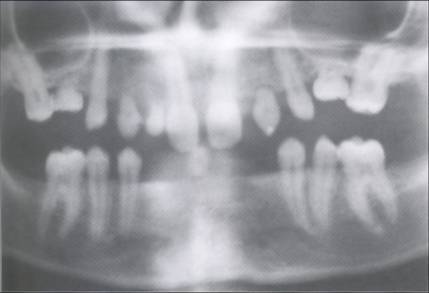 Turner’s hypoplasia