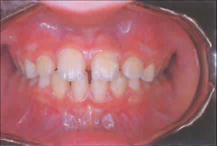 Turner’s hypoplasia