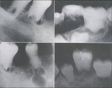 Turner’s hypoplasia