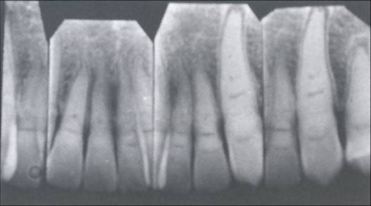 Turner’s hypoplasia