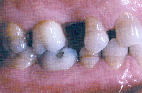 Turner’s hypoplasia