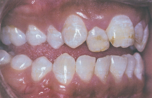 Turner’s hypoplasia