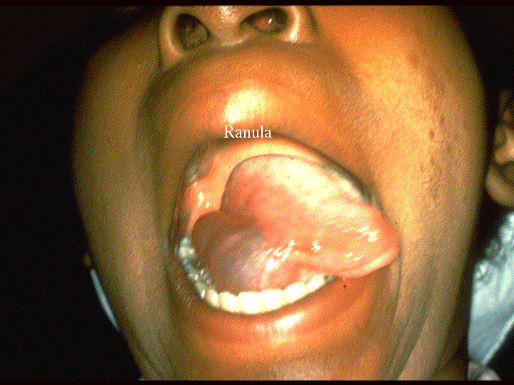 PowerPoint Presentation - Pediatric Oral Pathology