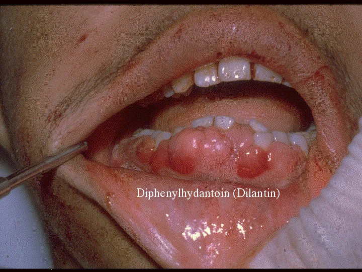 PowerPoint Presentation - Pediatric Oral Pathology