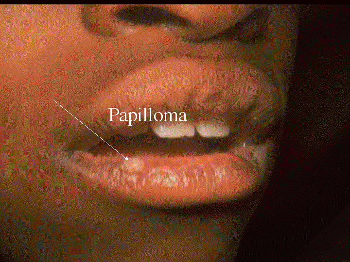 PowerPoint Presentation - Pediatric Oral Pathology