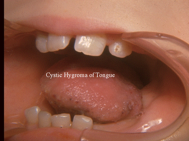 PowerPoint Presentation - Pediatric Oral Pathology