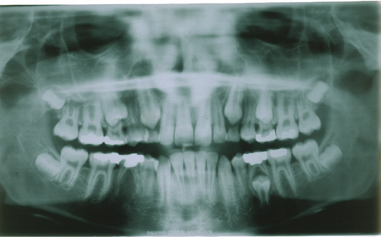Index of Radiographs
