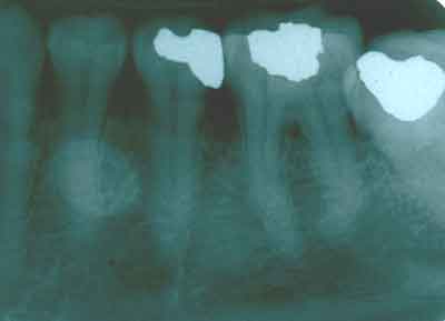 Nutrient Canal Radiograph