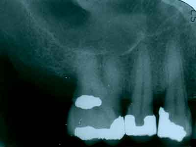 Periapical Radiology Exercise (March 2003)