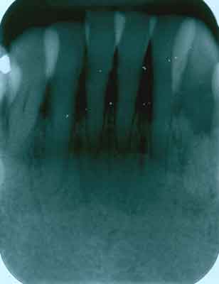 Periapical Radiology Exercise (March 2003)