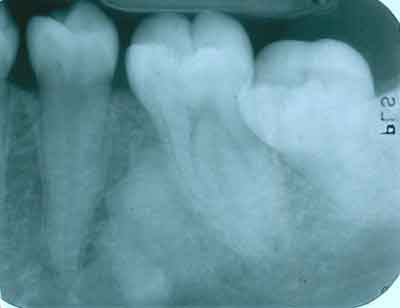 Periapical Radiology Exercise (March 2003)