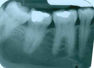 Mylohyoid Ridge Radiograph