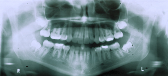Index of Radiographs