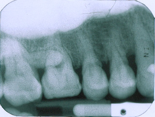 Torus Palatinus Radiograph