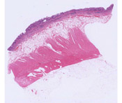 Ischaemic Colitis The Bmj Ischemic Colitis Imaging: Overview ...