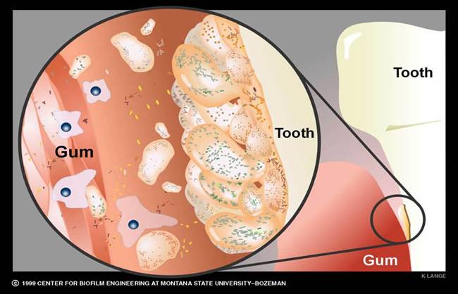 Microbiology of Periodontal Diseases