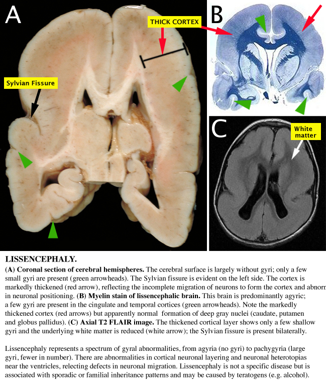 Neuropathology Atlas Update
