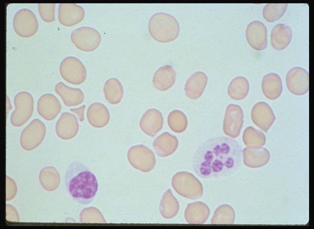 Update on (Approach to) Anemia