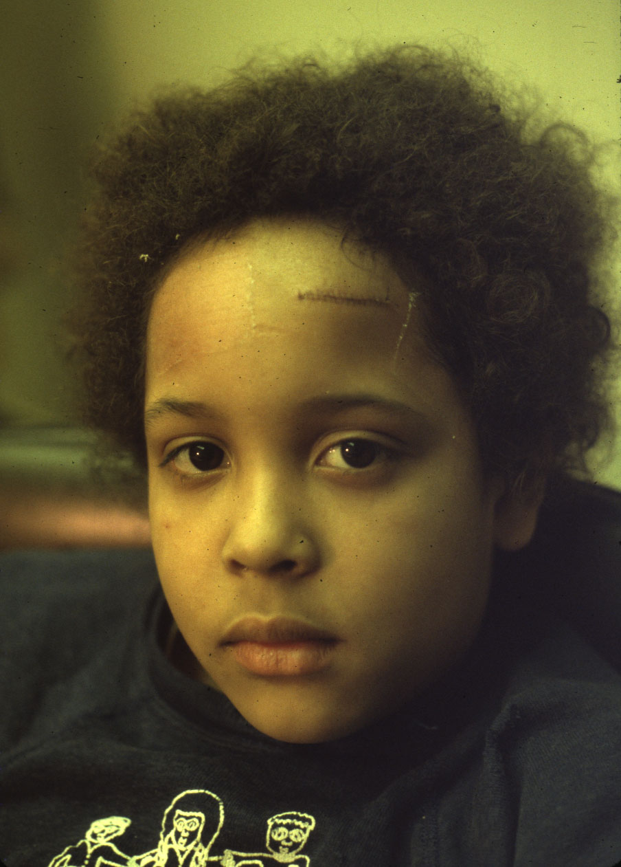 Family CD v.2 - Photo #1324 - 1986: Peter's second head gash