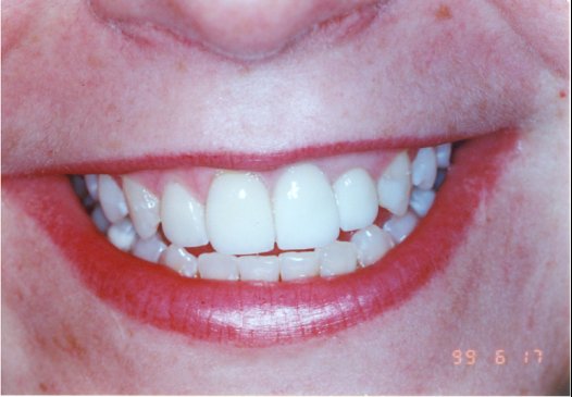 Figure 3: Finished restorations cemented into place. Notice the great ...