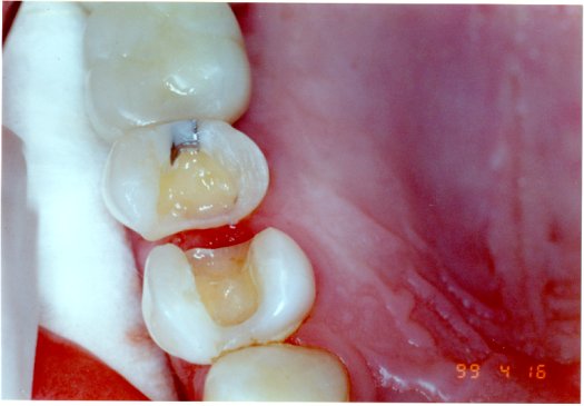Figure 2: Preparations made to receive ceramic inlay and onlay. (white ...