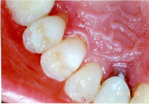 Figure 4: Close-up of "tooth" colored restorations.