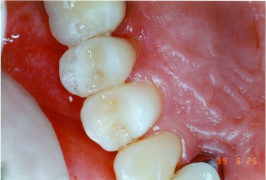 Figure 5: Another close-up of the Ceramic restorations. Notice how the ...