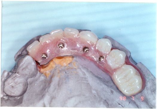 Figure 3: Another view of the prosthesis on the model/cast. Notice that ...