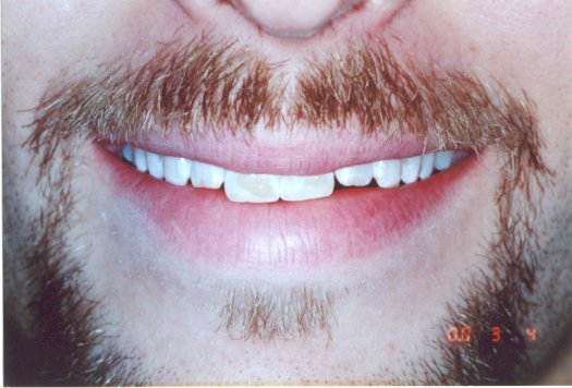 tooth enamel flaking off