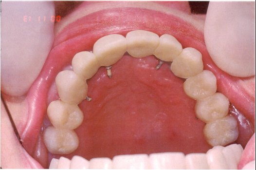 Figure 10: The maxillary "upper" view of the prosthesis, prior to final ...