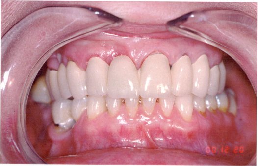 Figure 11: The finished result. Notice the excellent esthetic and ...
