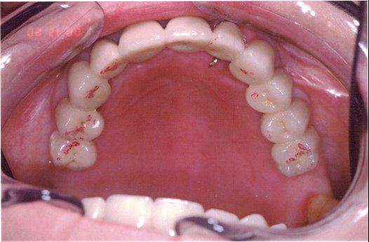 Figure 12: The maxillary "upper" view of the finished fixed partial ...
