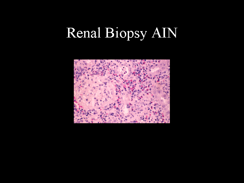 Renal Biopsy AIN