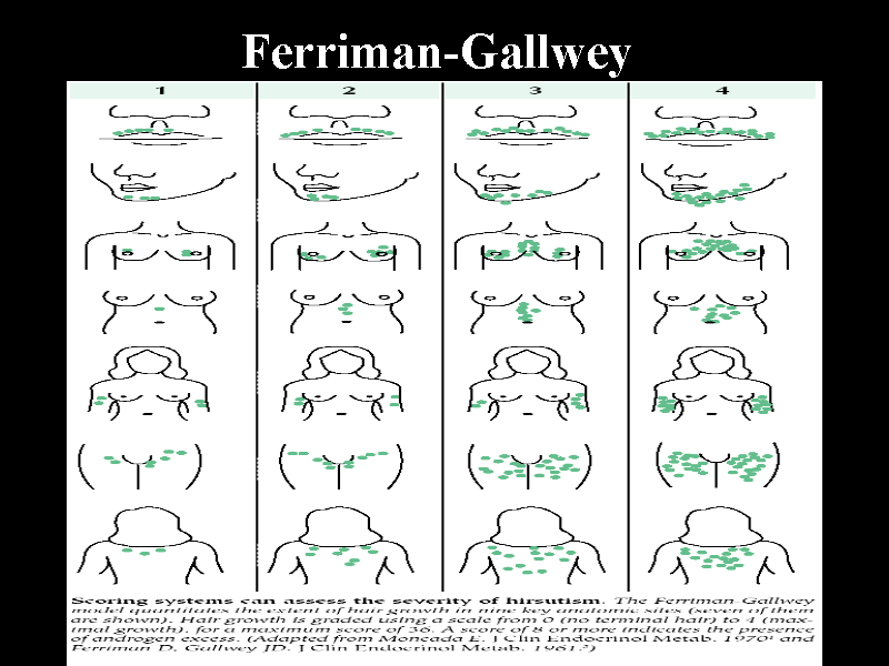 Ferriman-Gallwey