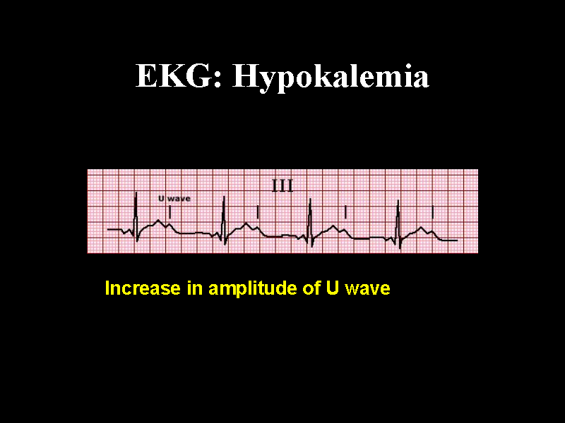 EKG: Hypokalemia